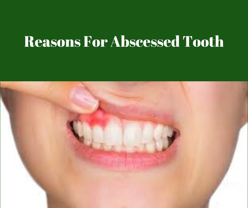 Abscessed Tooth