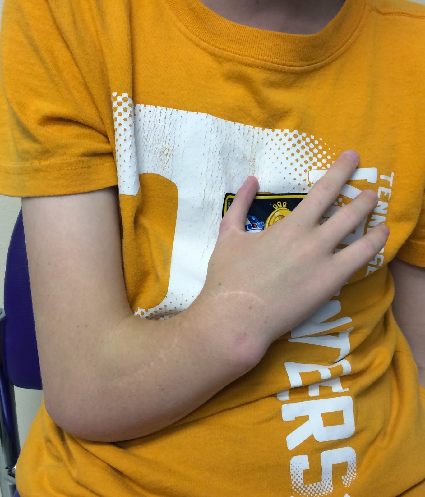 Type 2 Radial Longitudinal Deficiency | Congenital Hand and Arm ...