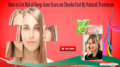 How to Get Rid of Deep Acne Scars on Cheeks Fast By Natural Treatment