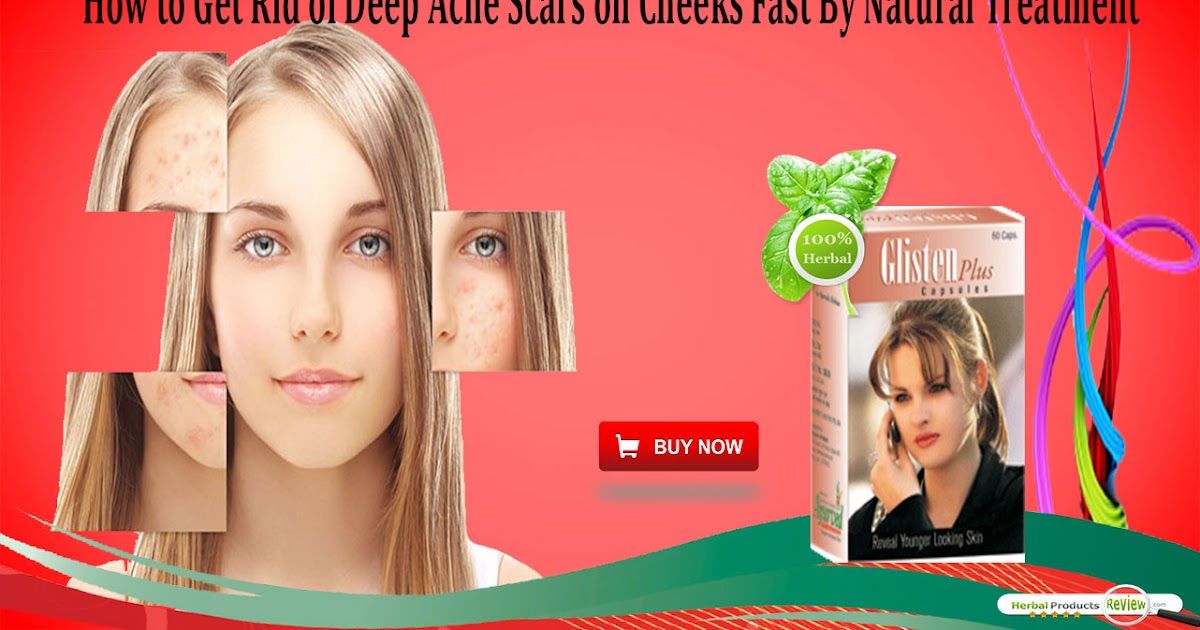 How to Get Rid of Deep Acne Scars on Cheeks Fast By Natural Treatment