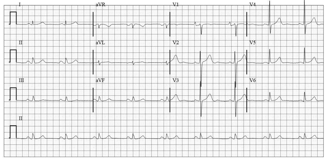 A 88 year old man man with a history of atrial fibrillation, his ...