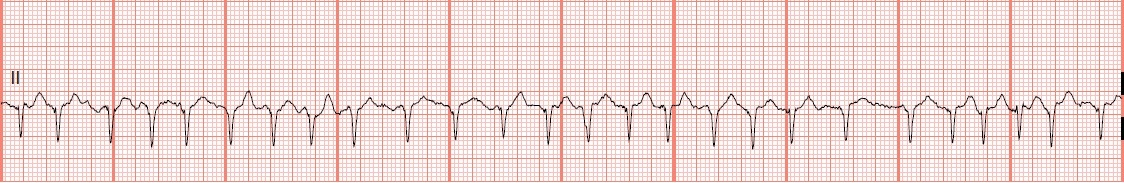 EKG Rhythm Strips 63