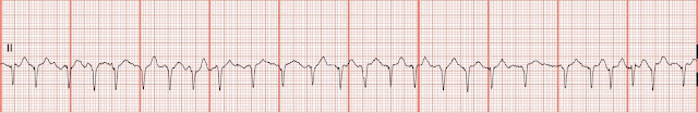 EKG Rhythm Strips 63