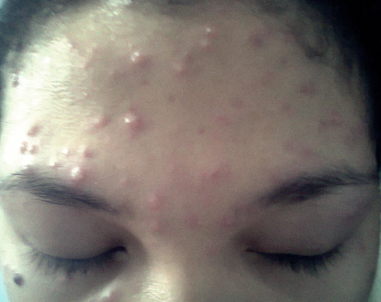 bulutong - philippin news collections