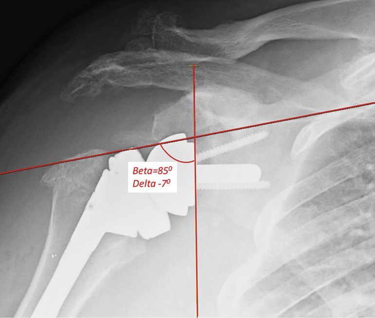 Shoulder Arthritis/Joint Replacement Rotator cuff tears: Dislocation in ...