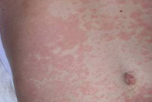 ASK DIS: Maculopapular Rash : Diagnosis
