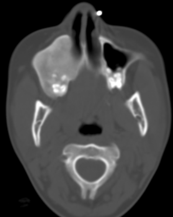 Fibrous Dysplasia of Maxilla - Radiology Imaging