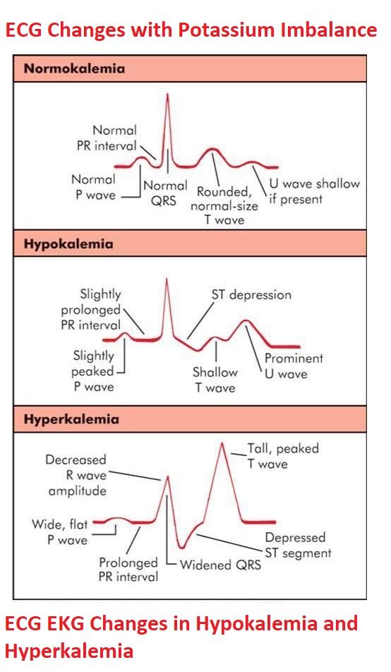 HYPOKALEMIA(electrolyte imbalance)