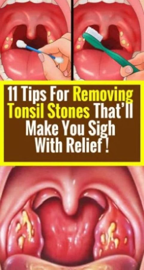 Tips On Removing Tonsil Stones With Relief ! - Healthy Lifestyle