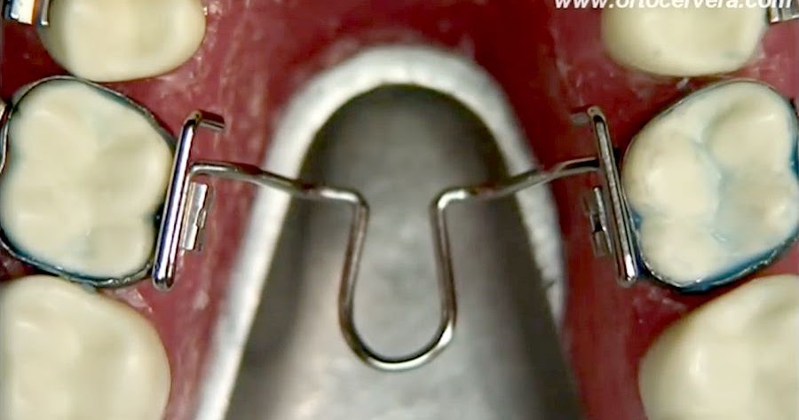 ORTODONCIA: Activación de la Barra de Goshgarian - Odonto-Tv