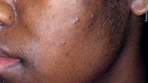 SABABU YA CHUNUSI NA TIBA ZAKE ~ SOKONI KWETU