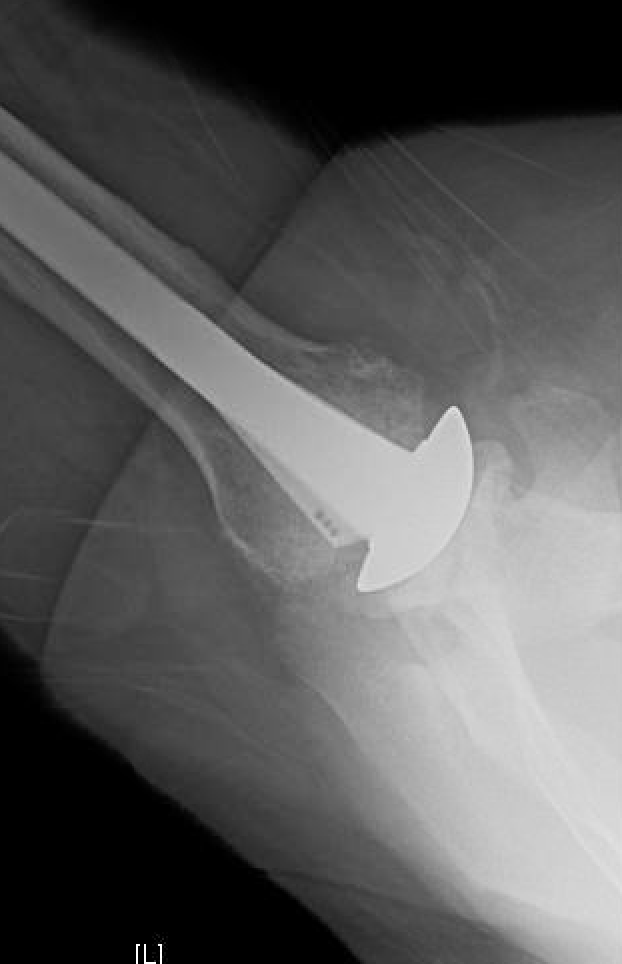 UW Shoulder and Elbow Academy: Ream and run for the retroverted glenoid ...