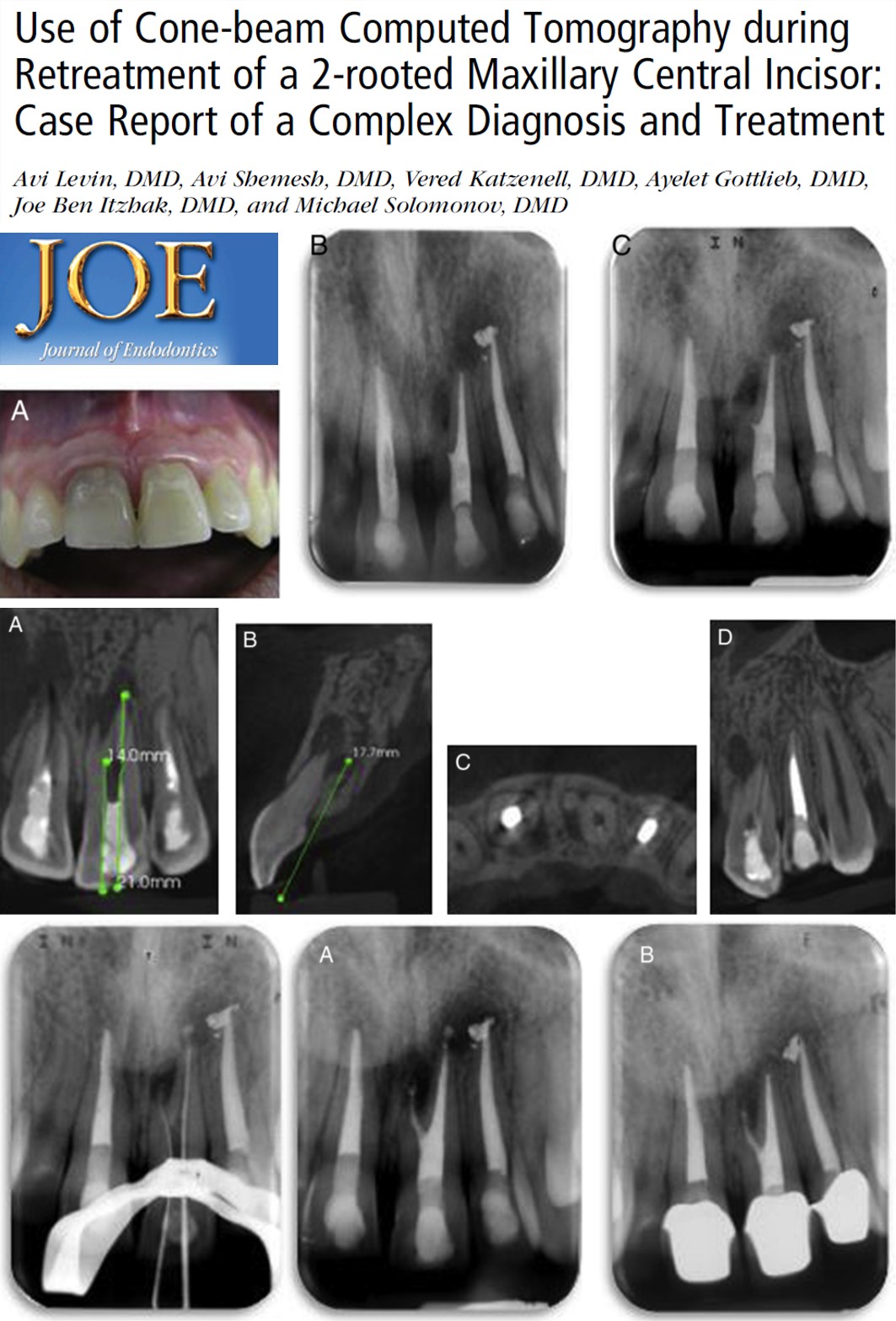 The Root Canal Anatomy Project: Two-Rooted Maxillary Central Incisor