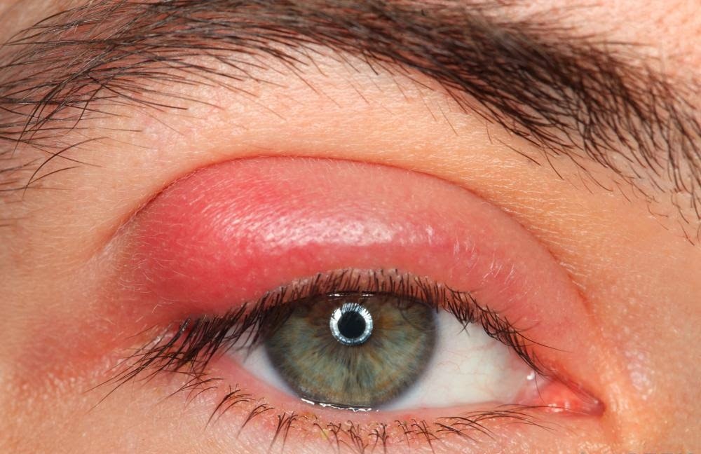 Ce que tu cherche : Quels sont les symptômes d'une infection à ...