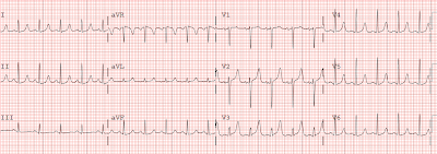 ECG features of hyperkalemia | Medical Knowledge
