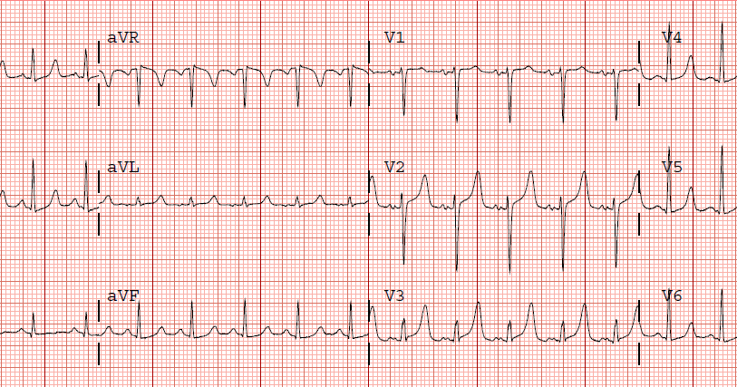 Dr. Smith's ECG Blog: Hyperacute T-waves that one might attribute to ...