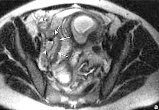 DR. JUAN HERNÁNDEZ ORDUÑA. : Casos especiales en apendicitis aguda texto