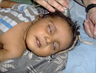 Pediatría Jovel: Deshidratación en Niños