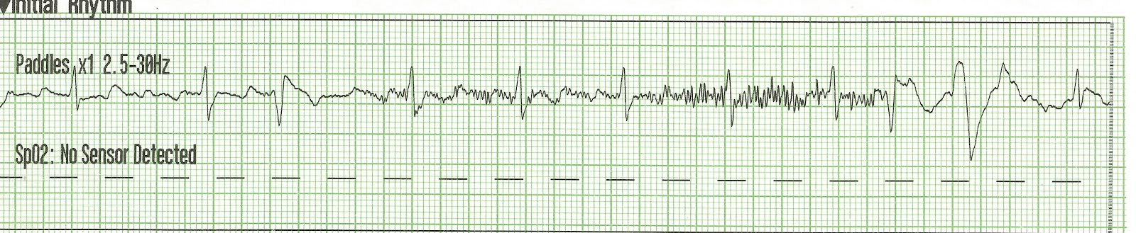 Float Nurse: ECG Rhythm Strips 86: Cardioversion of Atrial Flutter
