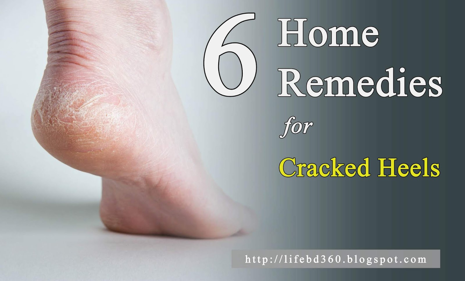 6 Best Home Remedies for Cracked Heels | Life in Bangladesh