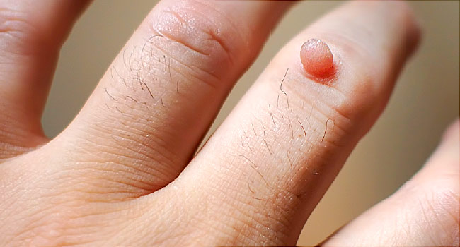WART – WHAT IS WART? WHAT TO DO WITH WART?
