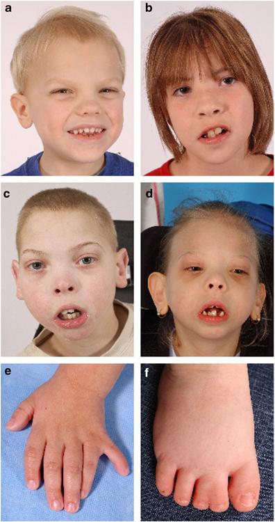 Noticias Genética Médica & more: Síndrome de Opitz C