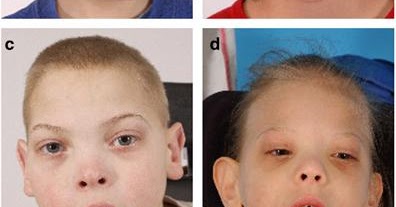 Noticias Genética Médica & more: Síndrome de Opitz C