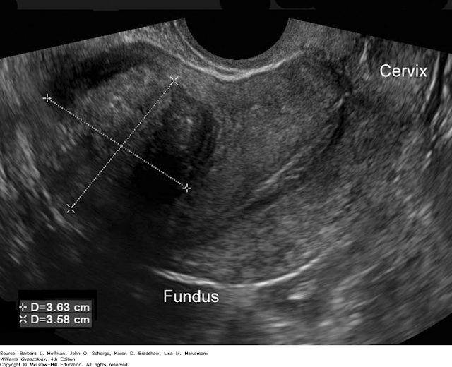 MEDICAL ULTRASOUND/FIBROMYOMA