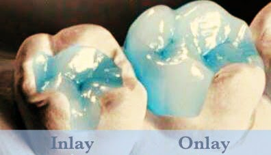 A Guide to Extra Coronal Restorations - TOOTH GERM