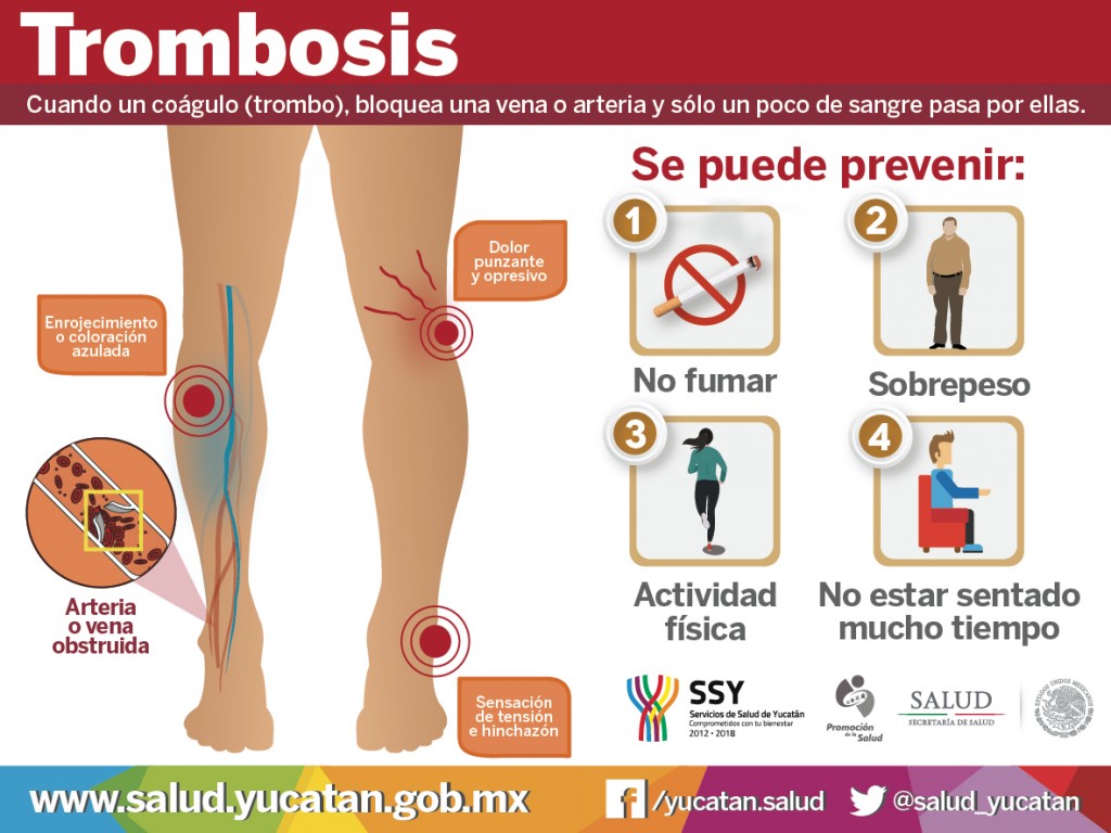 SALUD CON SENTIDOS: Trombosis, una enfermedad común y peligrosa.