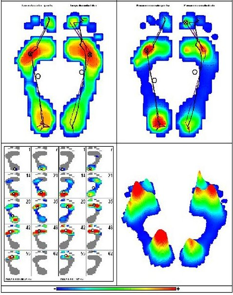 BAROPODOMETRIA - TESTE DA PISADA - Feetface - Clínica de Podologia e ...