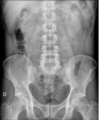 PROTOCOLO DE ESTUDIOS ESPECIALES: TRÁNSITO INTESTINAL