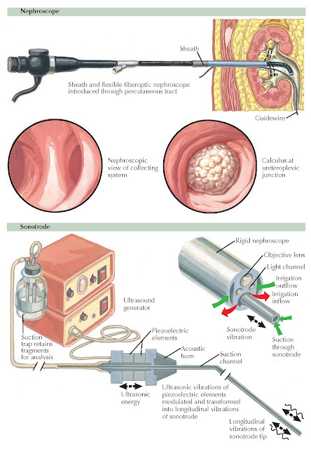 PERCUTANEOUS NEPHROLITHOTOMY - pediagenosis