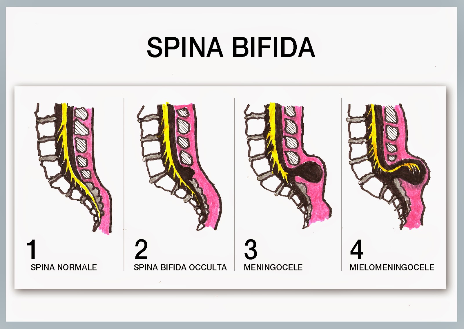 Medicine Health Group Skoliosis And Spina Bifida