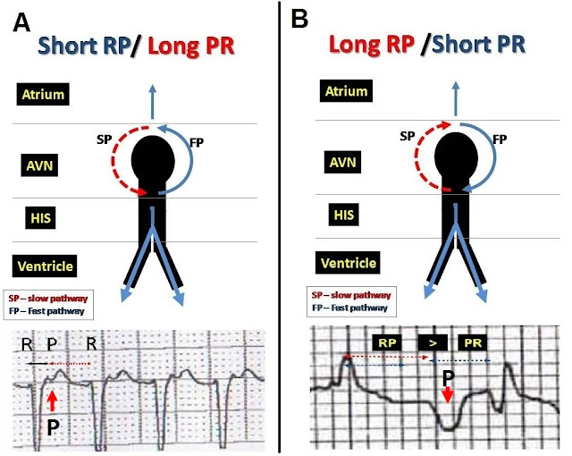 ECG Rhythms: There is a reason to check the initiation of a tachycardia