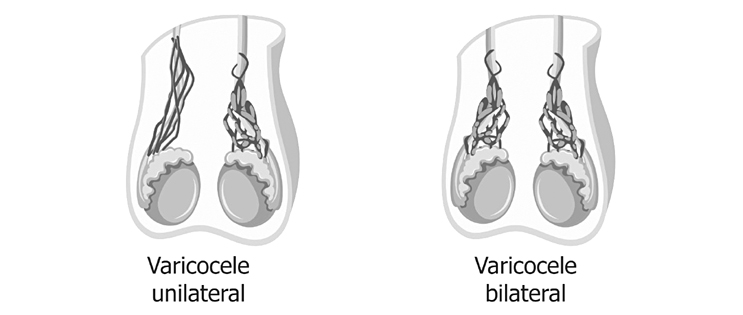 Presencia Alteña: Varicocele