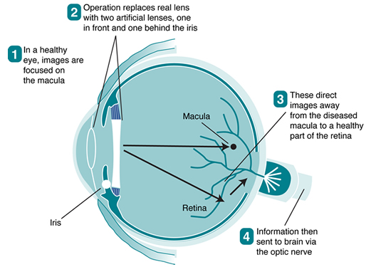 Macular Degeneration Society (Singapore): IOL-Vip restores vision in ...