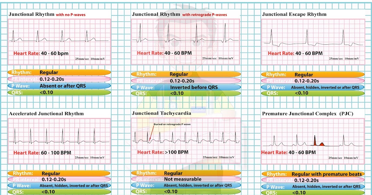 ECG Educator Blog : Junctional Rhythms