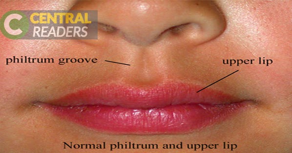 DO YOU HAVE A GAP BETWEEN THE NOSE AND UPPER LIP? YOU WILL BE AMAZED ...