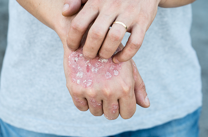 Kusta Bukan Kutukan, Begini Cara Penanganan yang Tepat! Anggi Putri