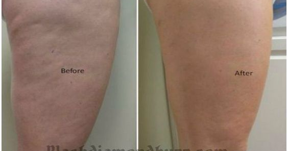How to Get Rid of Cellulite Fast – Super Fast in This Summer 7 Days ...