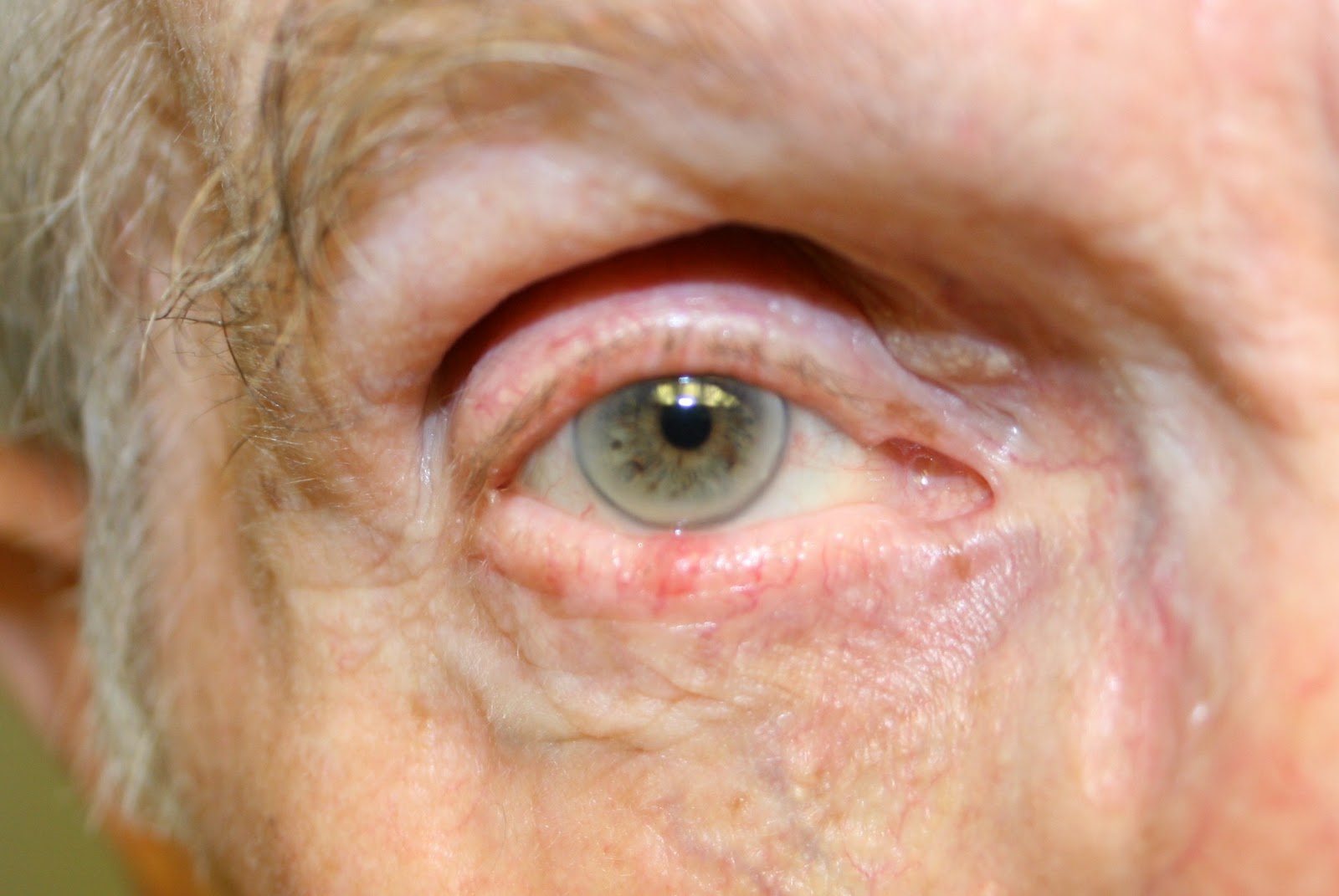 Photos For Blepharitis YOUNG DOCTORS RESEARCH FORUM photos-for-blepharitis-young-doctors-research-forum