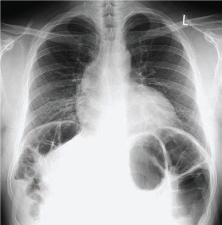 ABC Radiology Blog: Chilaiditi syndrome