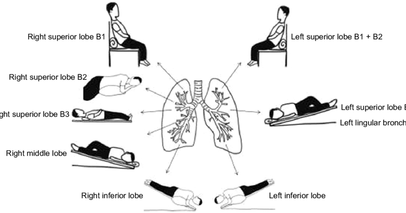 Treating pneumonia in an emergency