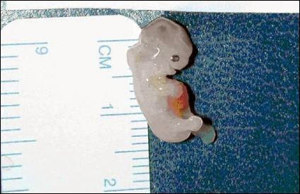 The Fetus Collection: PHOTO: 8 Week Fetus From Ruptured Tubal Pregnancy