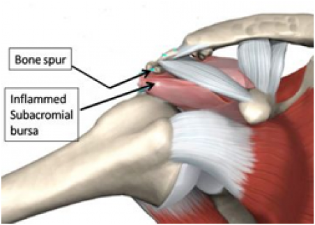 MYO Therapy & Healthcare Institute: Rotator Cuff Tears