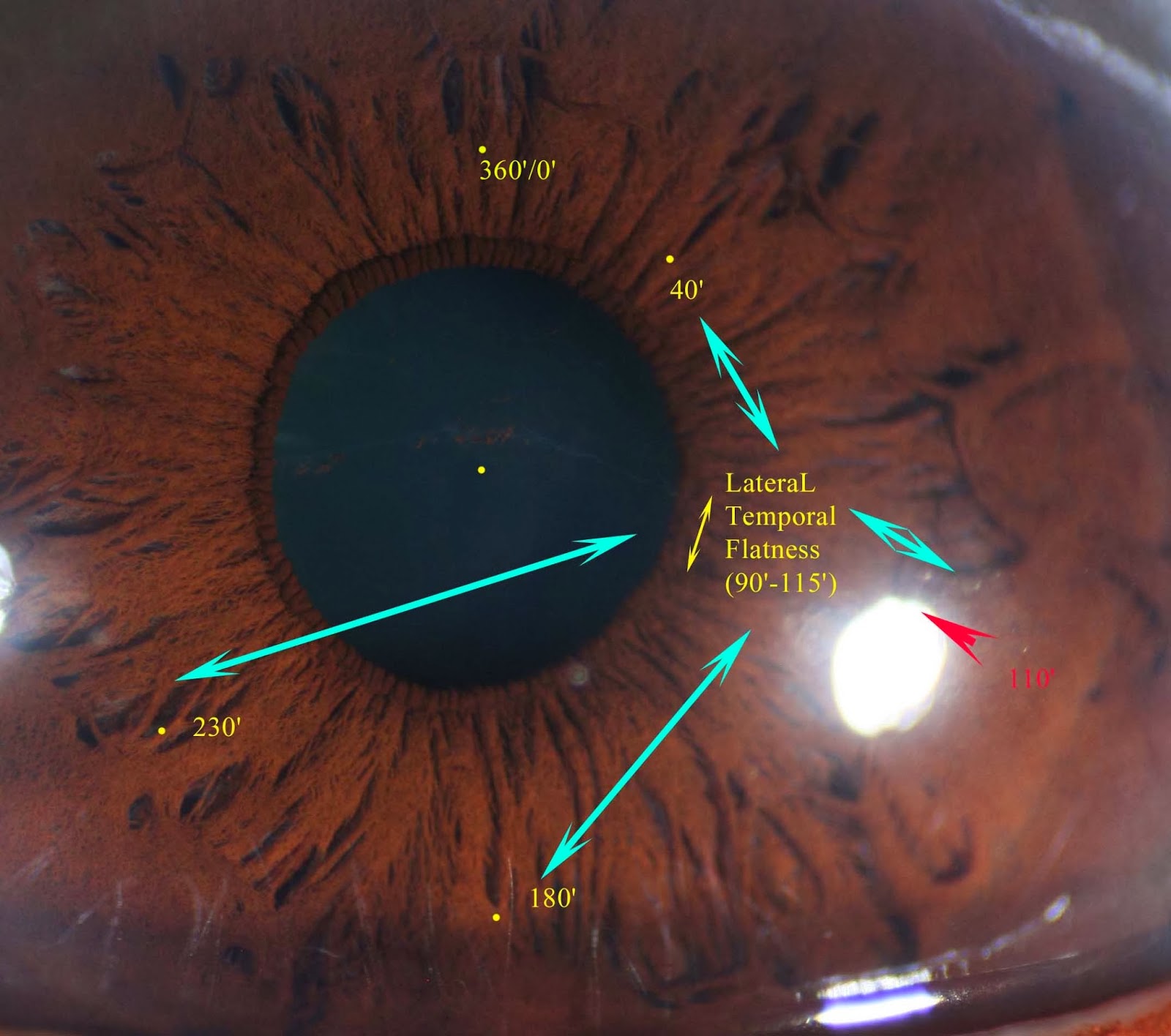 Modern & Multidimensional Iridology: IPB Morphologies, Pupil Flattening ...
