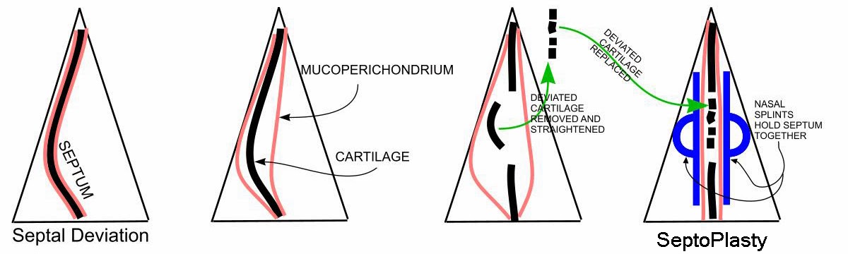 Septoplastic Treatmetment