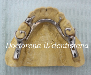My Dental Diary: CO-Cr. RPD