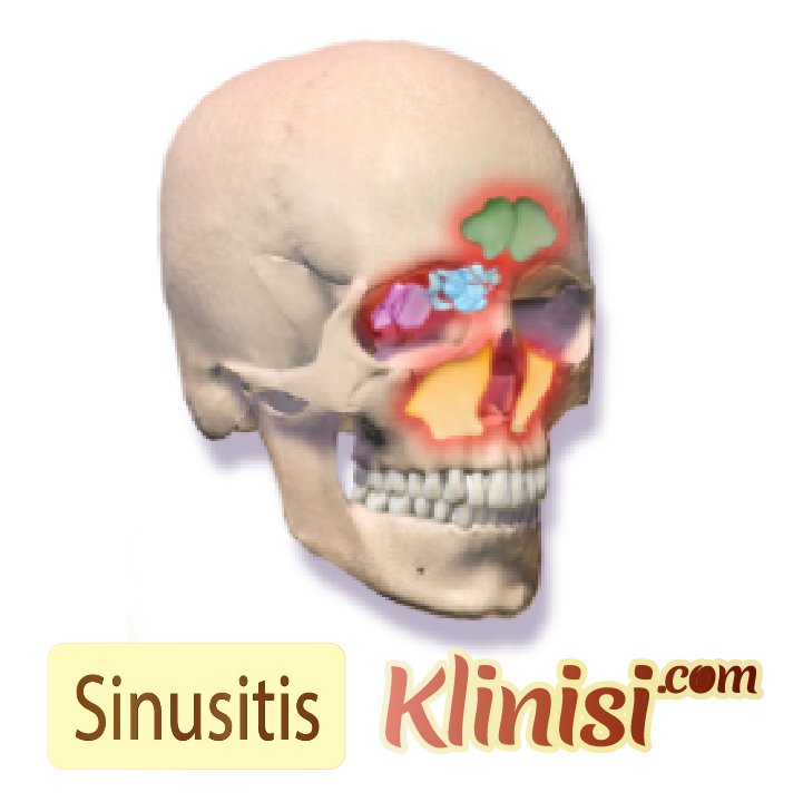Sinusitis / Rhinosinusitis Akut / Kronik / Penyakit Saluran Napas